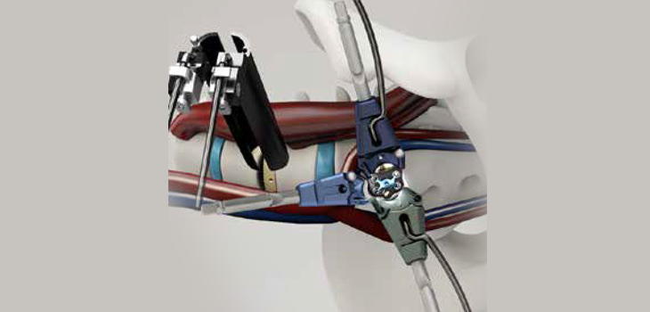 Divergence-L Interbody Fusion Device ® | Michelson Technology